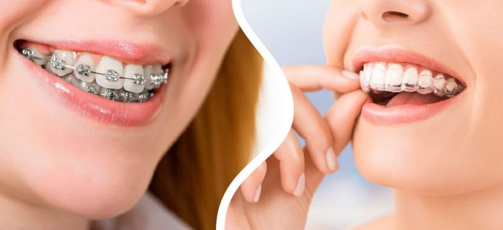 Tipos de ortodoncia invisible, la mejor alternativa a los brackets ...